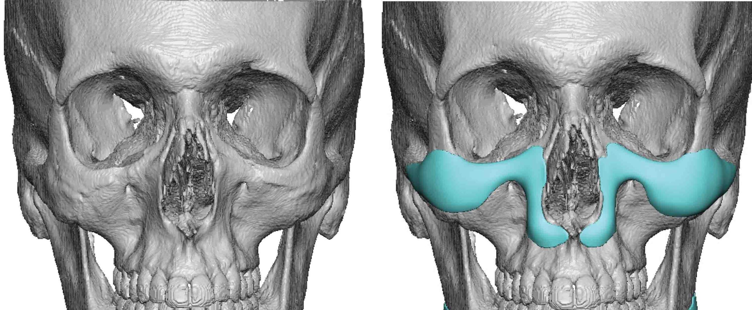 Custom Midface Implant designs front view Dr Barry Eppley - Explore ...