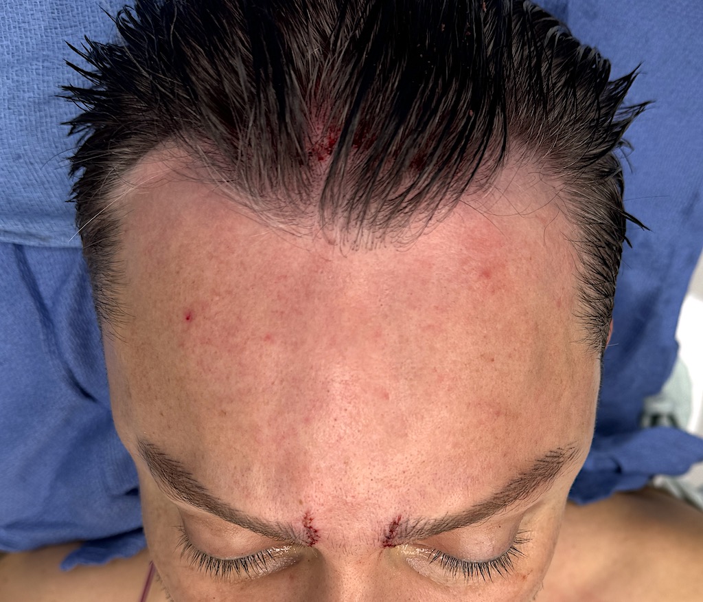 Plastic Surgery Case Study - Custom Two-Piece Forehead-Temporal Wrap ...