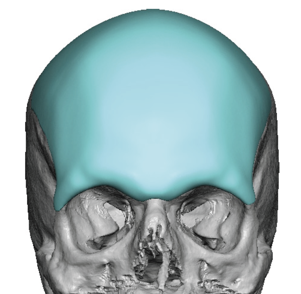 Plastic Surgery Case Study - The Male Custom Forehead-Brow Bone Implant ...