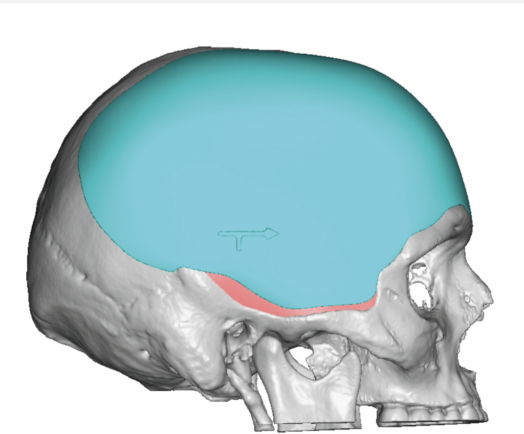 Plastic Surgery Case Study - Custom Two-Piece Forehead-Temporal Wrap ...