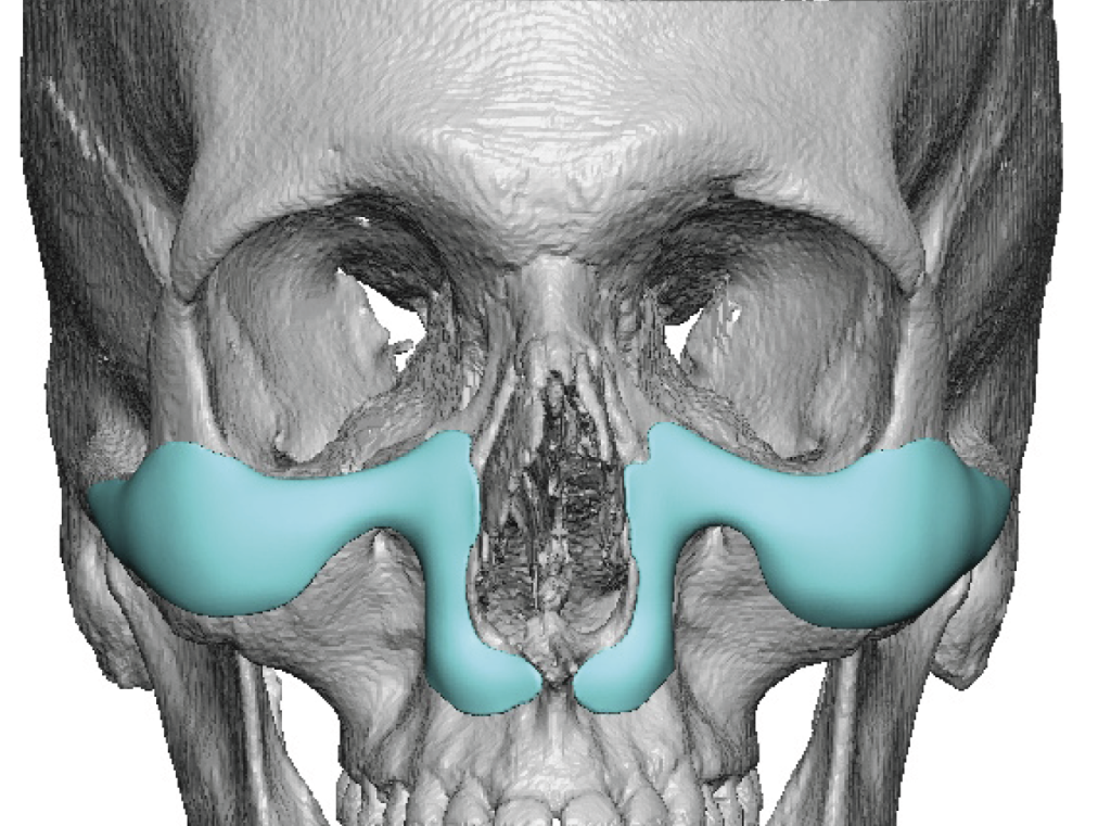 Plastic Surgery Case Study - Custom Midface Pyriform Aperture ...