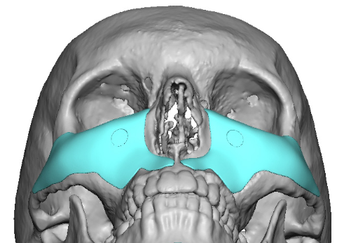 Technical Strategies - Intraoperative Placement of Custom Midface ...