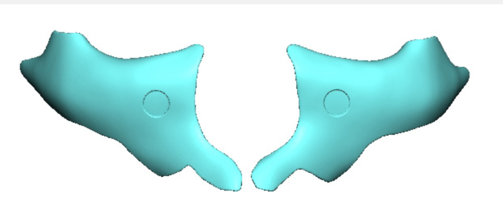 Technical Strategies - Intraoperative Placement of Custom Midface ...