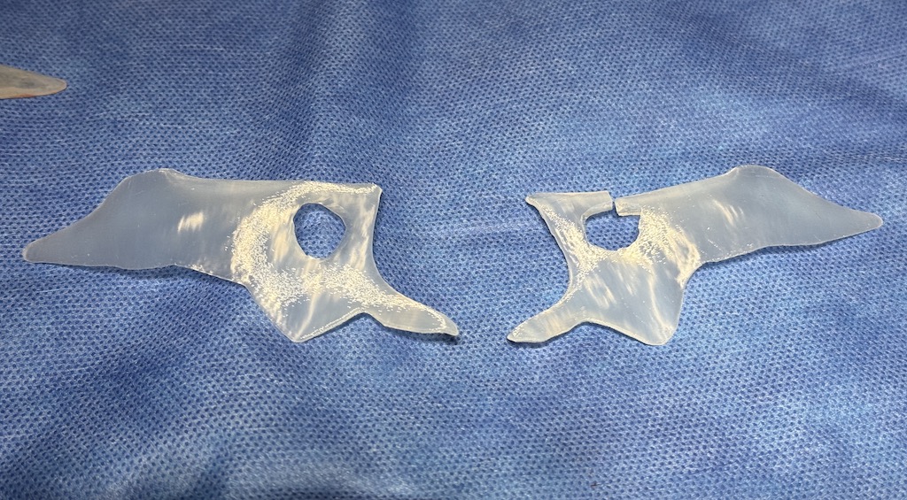 custom midface oimplany modified Dr Barry Eppley - Explore Plastic Surgery