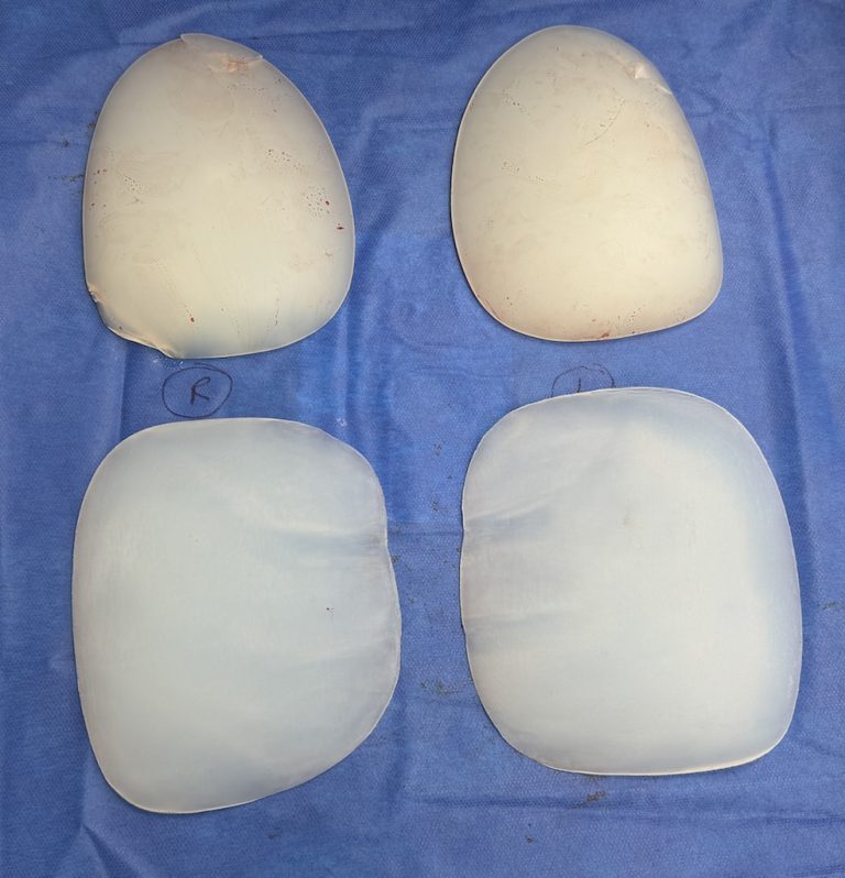 Plastic Surgery Case Study - Custom Pectoral Implant Replacements in ...