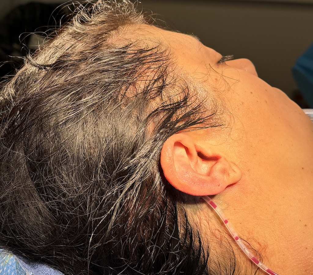 custom right head widening implant placement:closure Dr Barry Eppley ...