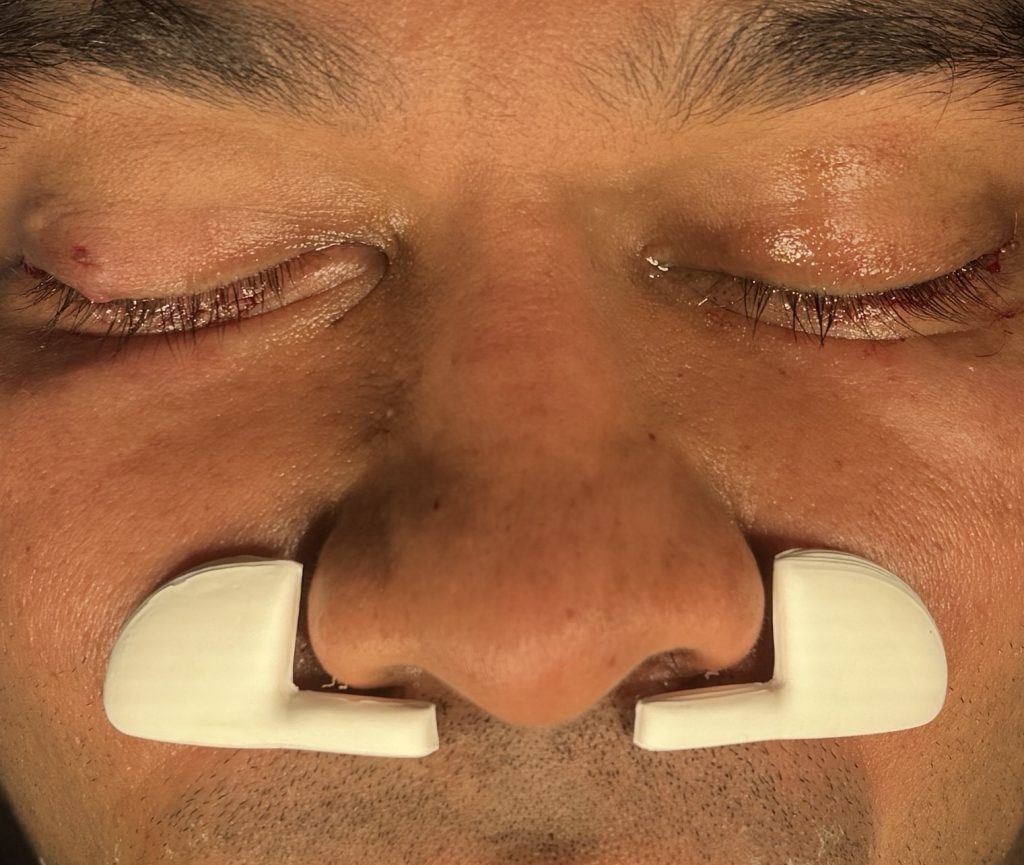 Technical Strategies - Intraoperative Shaping of ePTFE Paranasal ...