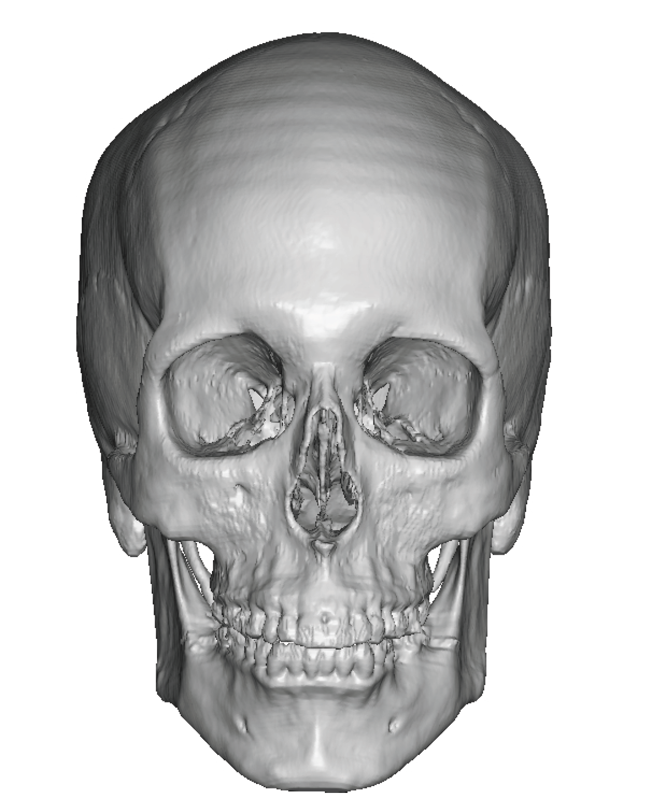 Plastic Surgery Case Study - Female Submuscular Head Widening Implants ...