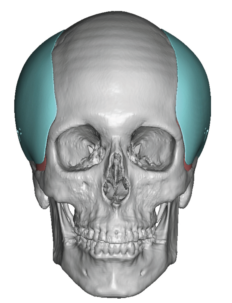 Plastic Surgery Case Study - Female Submuscular Head Widening Implants ...