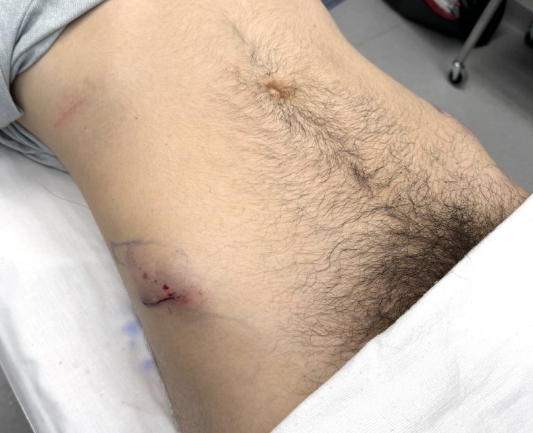 Plastic Surgery Case Study - Male Prominent Iliac Crest Reductions ...
