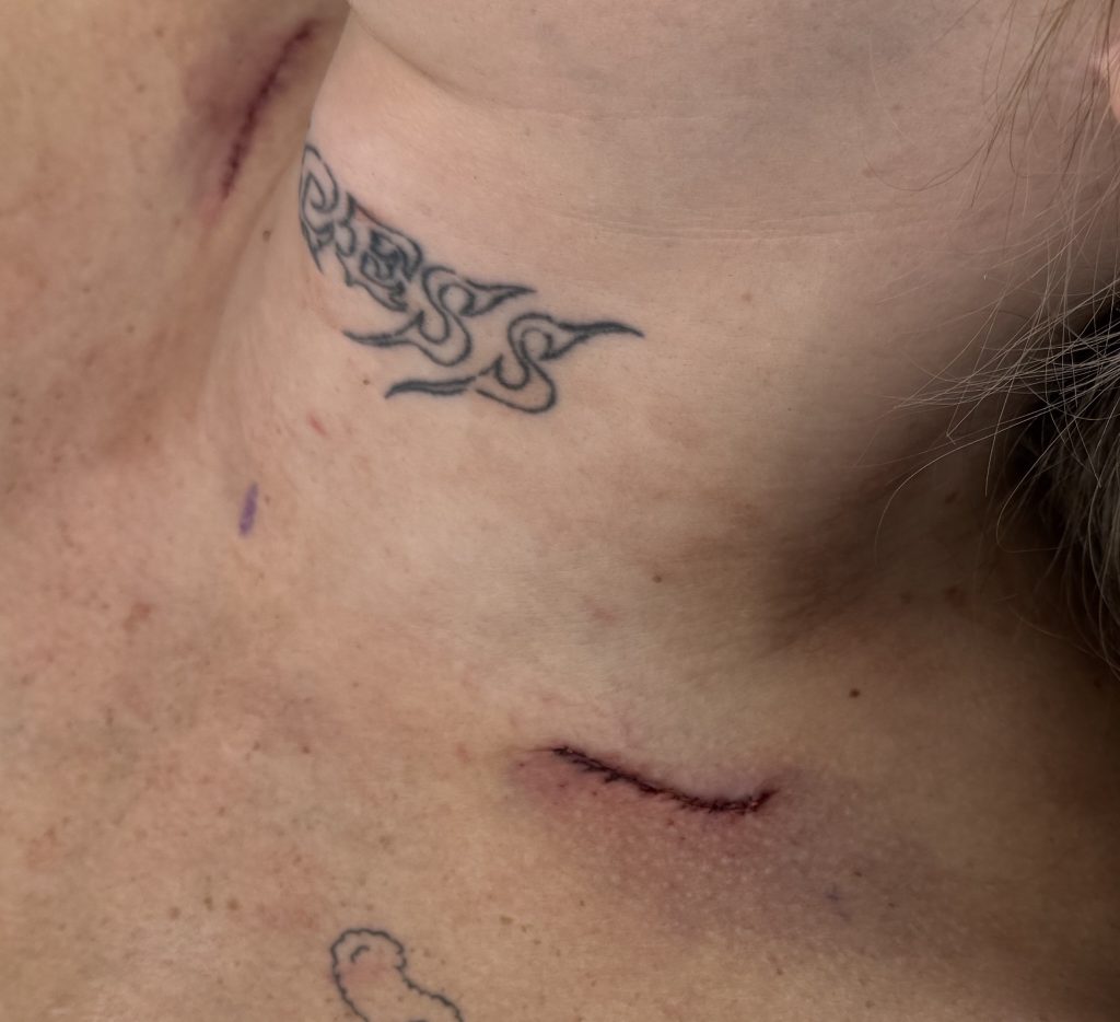 The RSTL Placement of the Supraclavicular Fossa Incisions in Shoulder ...