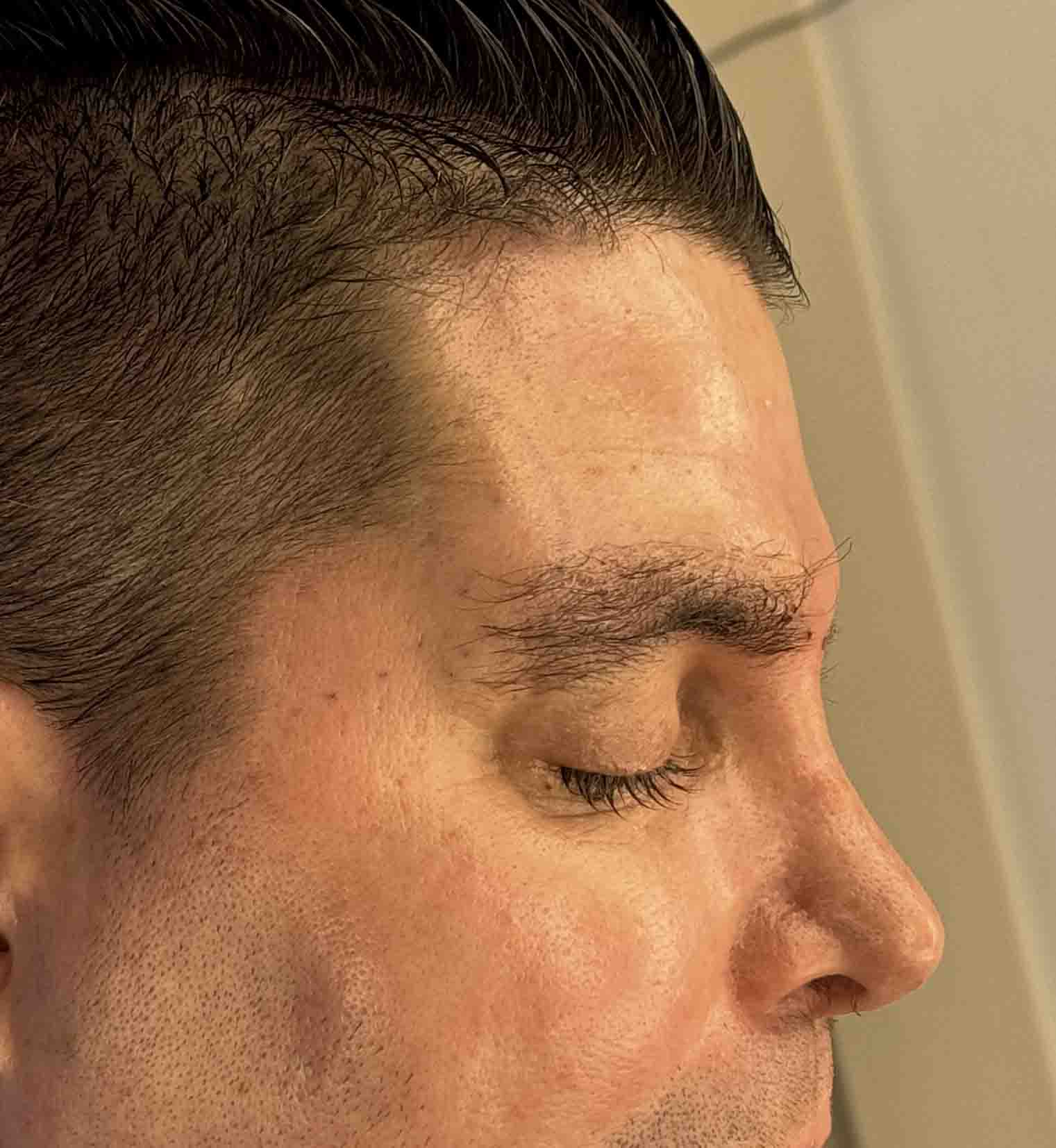 male custom forehead-brow bone Implant intraop side 1 Dr Barry Eppley ...