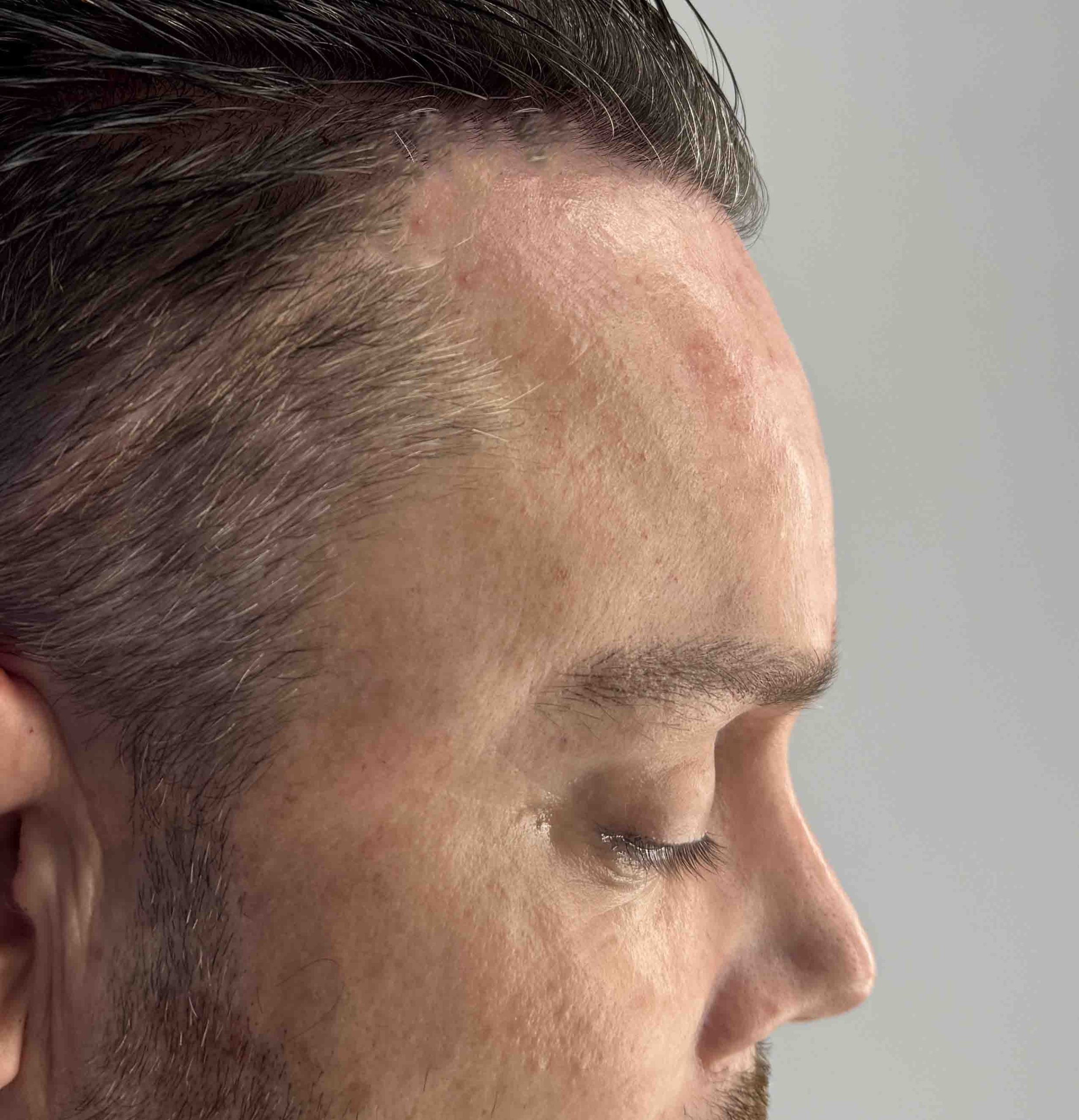 male custom forehead implant intraop side 2 Dr Barry Eppley - Explore ...