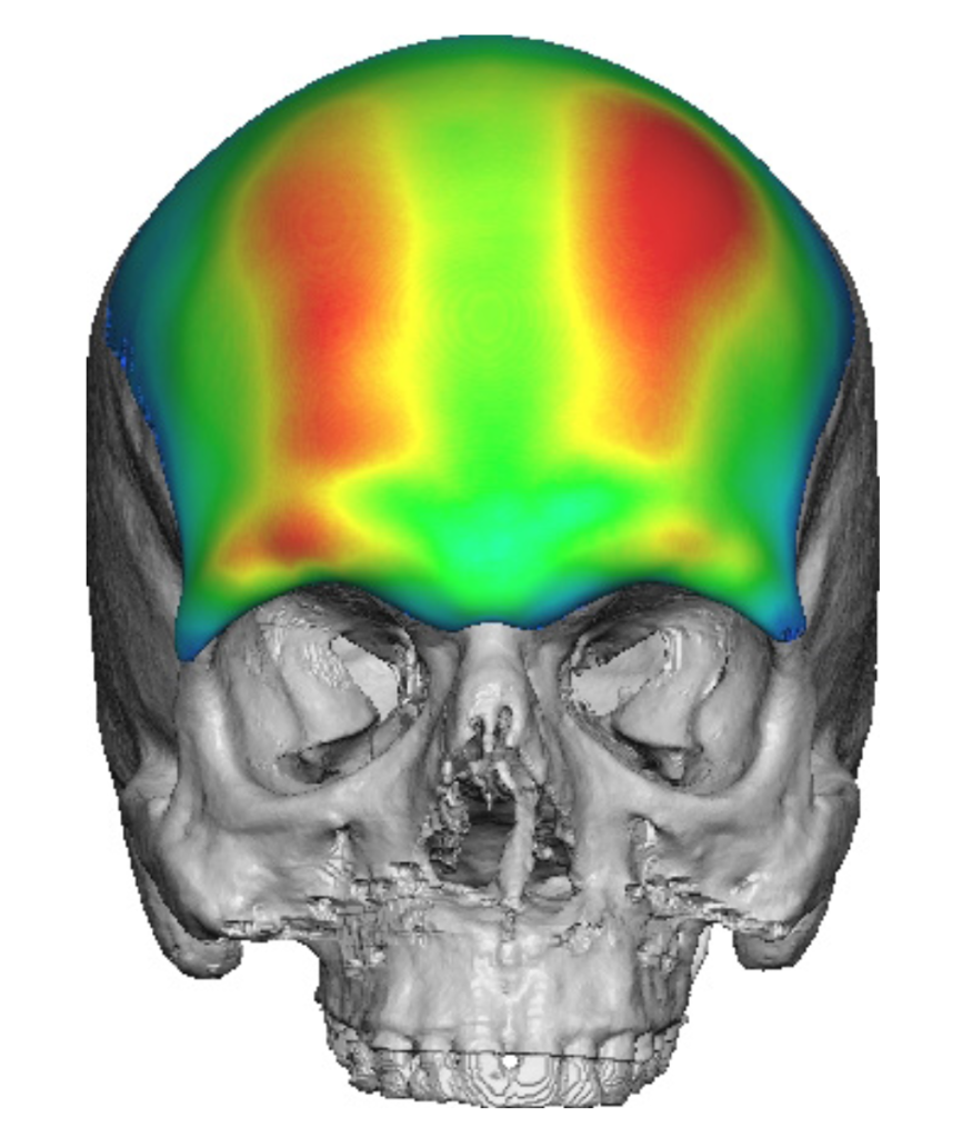 Plastic Surgery Case Study - The Male Custom Forehead-Brow Bone Implant ...
