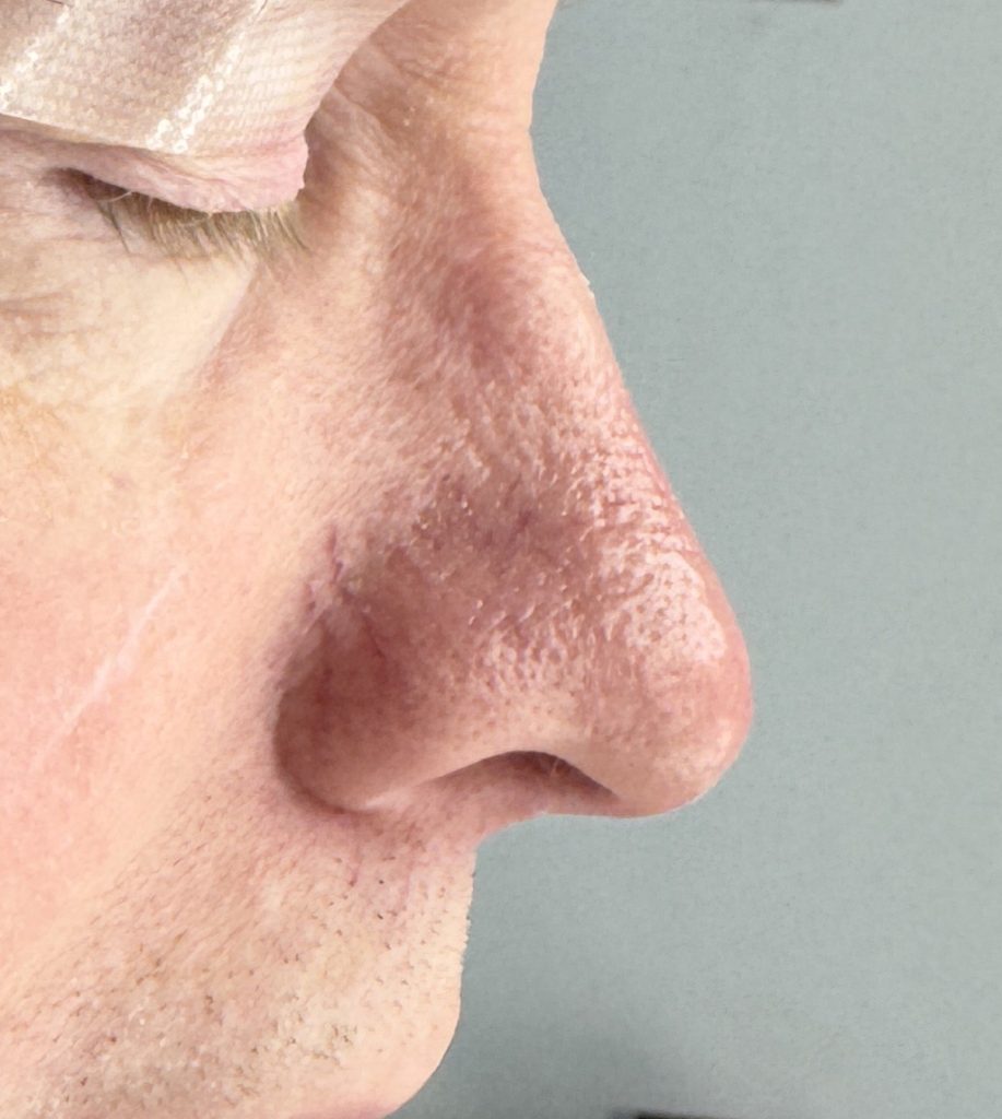 Plastic Surgery Case Study - Secondary Male Nasal Tip Rejuvenation ...