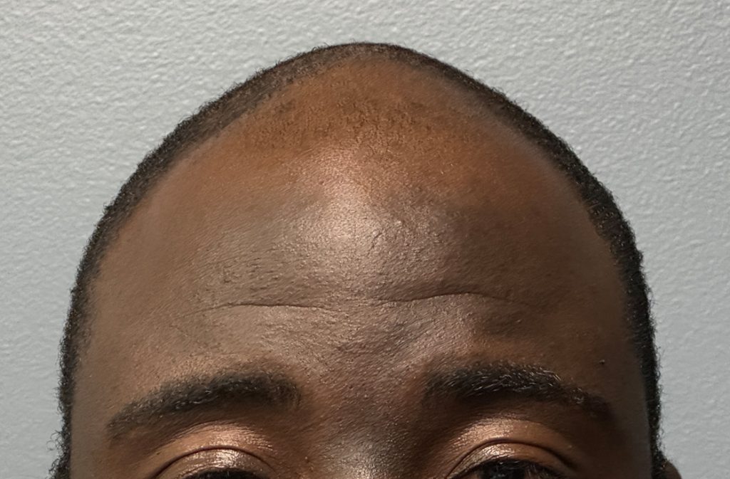 Plastic Surgery Case Study - Male Crown of the Skull Reduction with ...