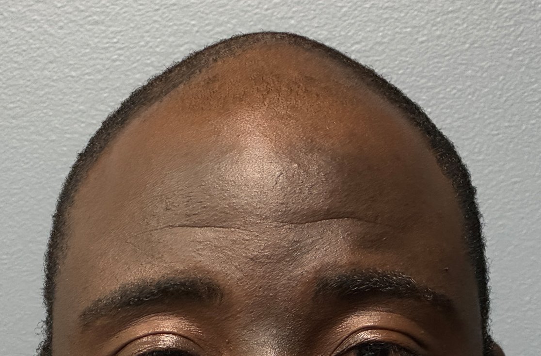 male skull reduction front 1 Dr Barry Eppley copy - Explore Plastic Surgery