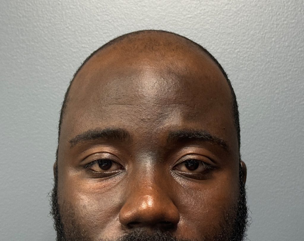 male skull reduction front 2 DR Barry Eppley - Explore Plastic Surgery