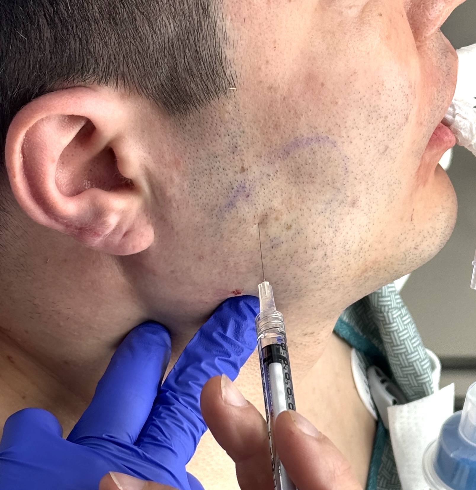 Botox Injections for Reducing The High Bulge of Masseteric Muscle ...