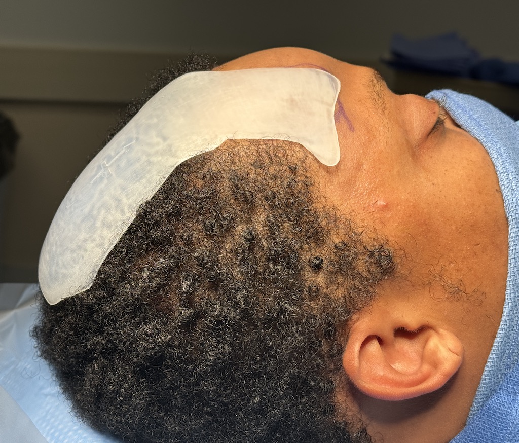 Plastic Surgery Case Study - Custom Skull Implant for Right Frontal ...