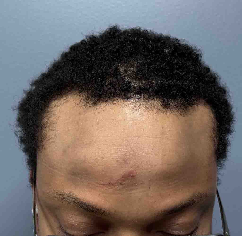 right forehead-skull depression front 1 Dr Barry Eppley - Explore ...