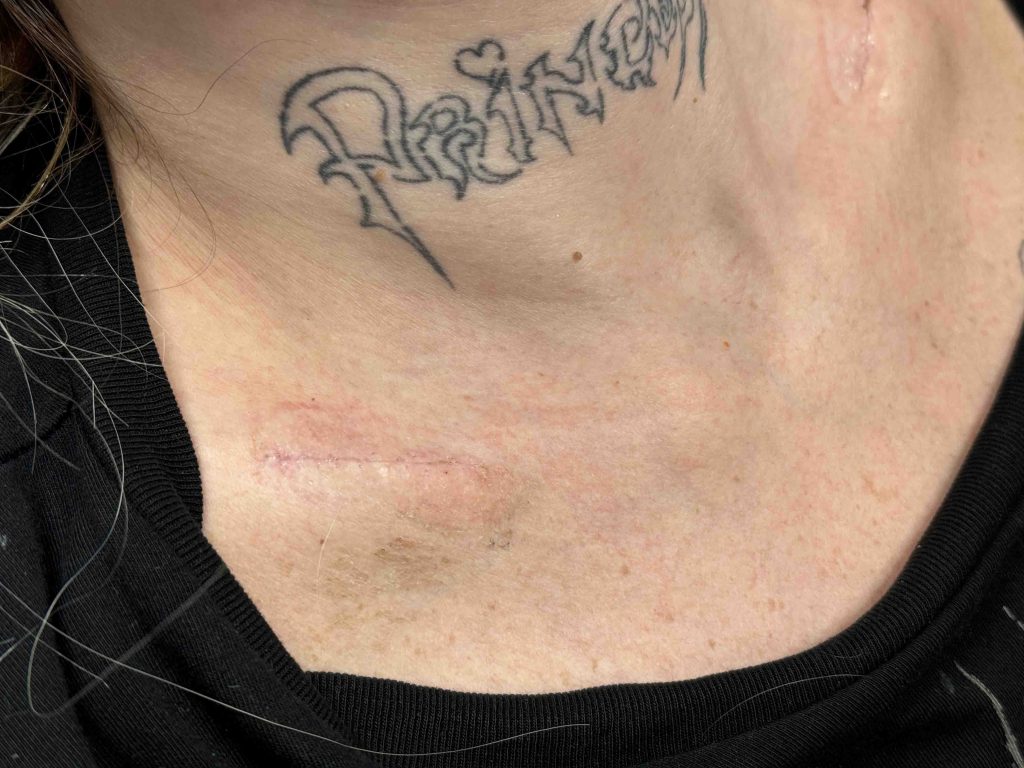 The RSTL Placement of the Supraclavicular Fossa Incisions in Shoulder ...