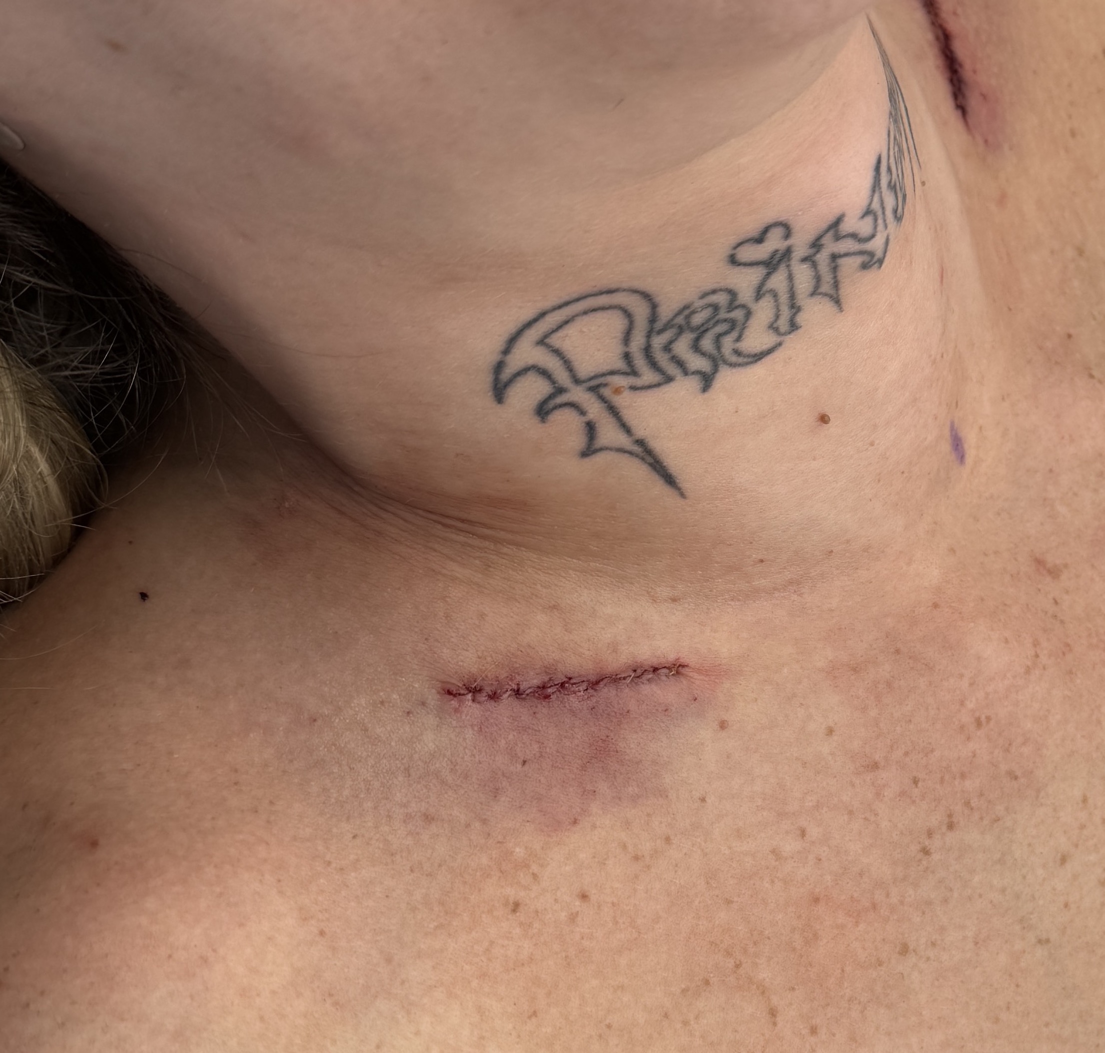 right shoulder reduction incision closure Dr Barry Eppley - Explore ...