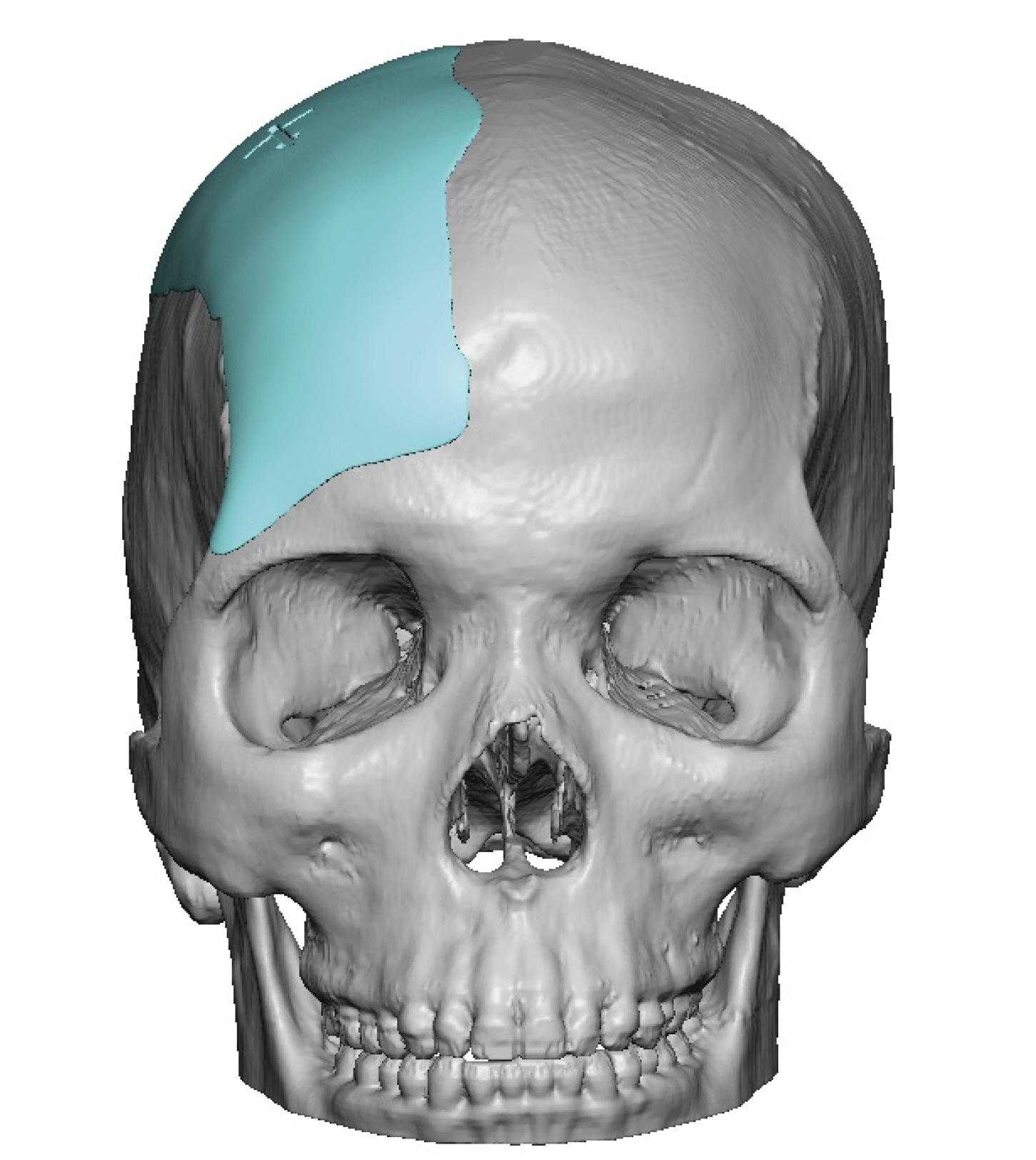 right skull asymmetry implant design diurect front view Dr Barry Eppley ...