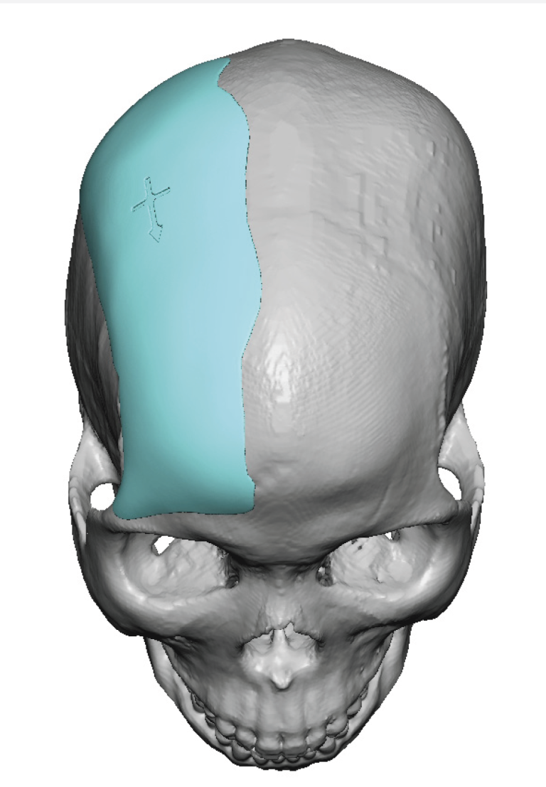 Plastic Surgery Case Study - Custom Skull Implant for Right Frontal ...