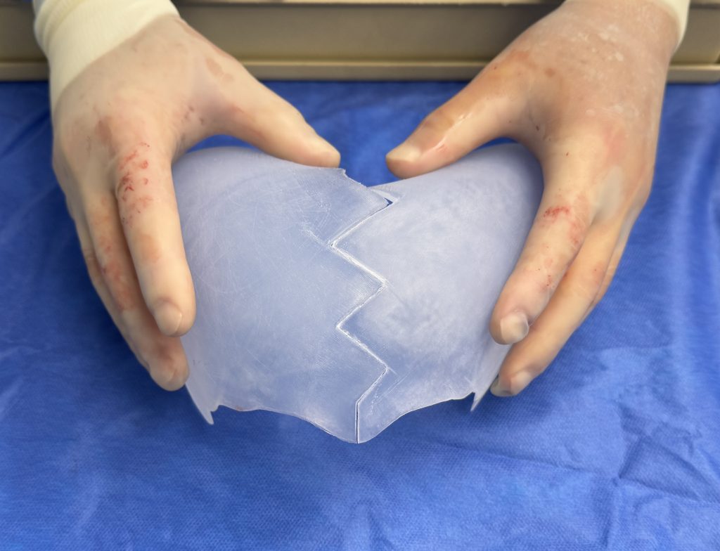 Plastic Surgery Case Study - Custom Two-Piece Forehead-Temporal Wrap ...