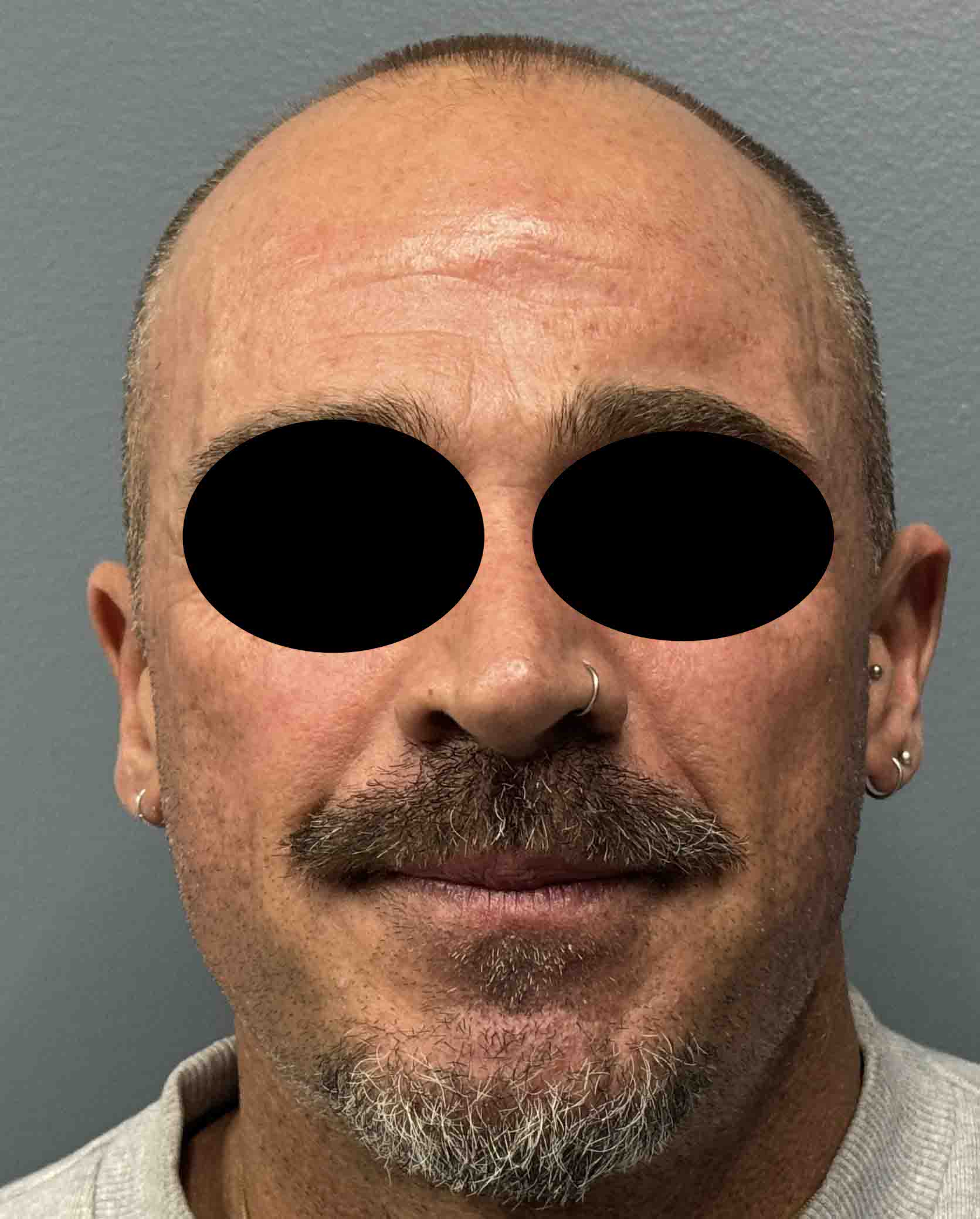 upper otoplasty front 1 Dr Barry Eppley copy - Explore Plastic Surgery