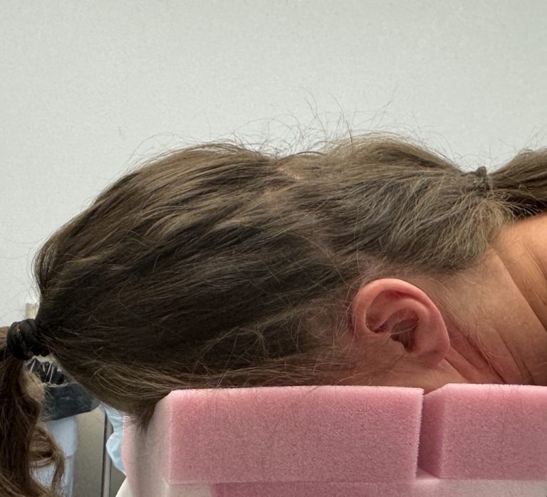 Plastic Surgery Case Study - The Two Stage Technique in Female Large ...