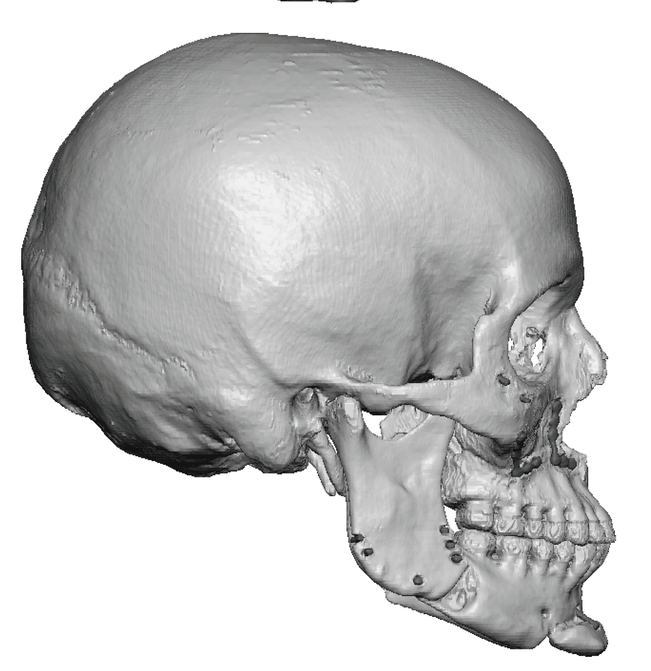 3D craniofaciual CT scan side view Dr Barry Eppley - Explore Plastic ...