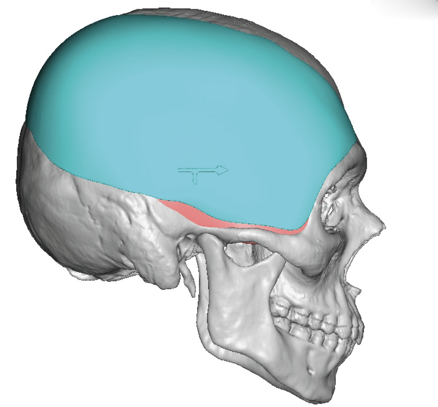 Bilateral Wrap Around skull implants design side view Dr Barry Eppley ...