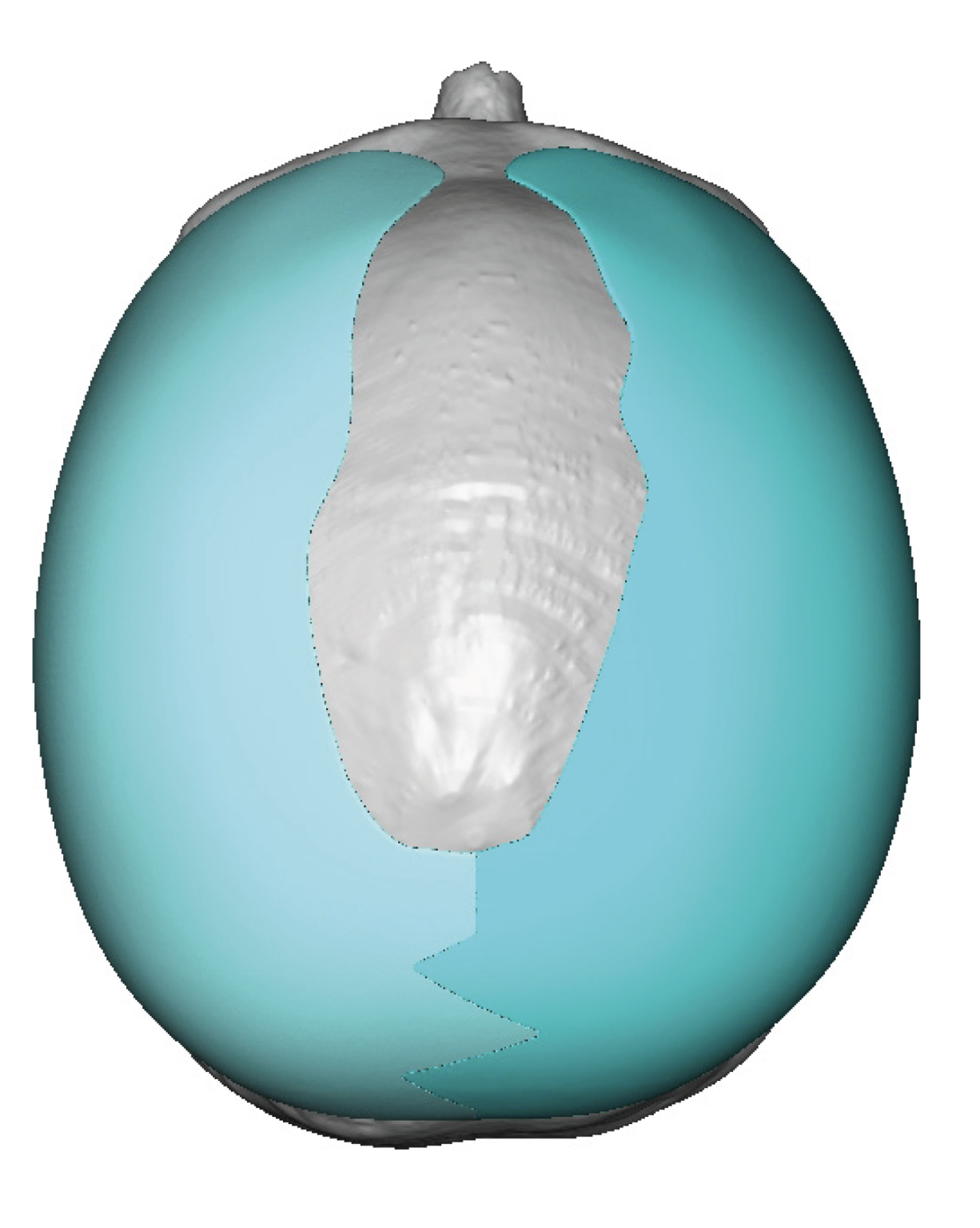 Plastic Surgery Case Study - Type 4 Temporal Augmentation Wrap Around ...
