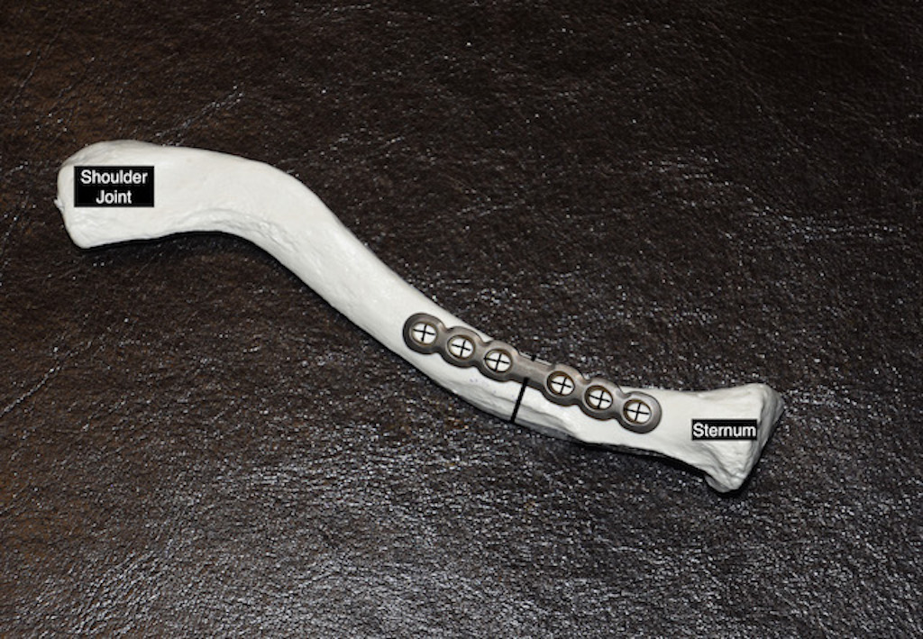 Bone Fixation Plate for Clavicular Reduction Osteotomies Dr Barry ...