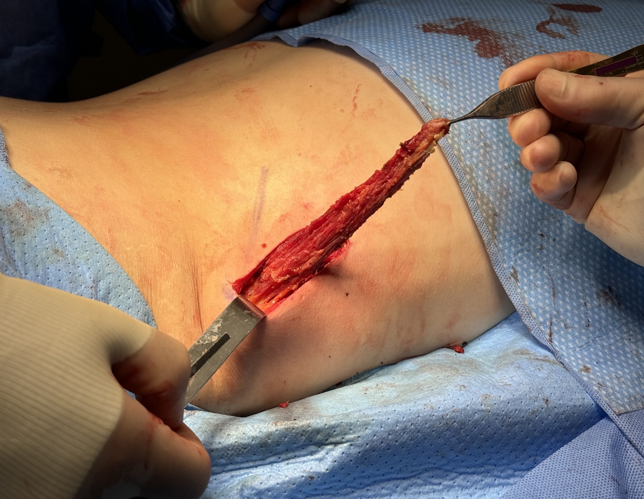 Technical Strategies - The Role of Latissimus Dorsi Muscle Removal In ...