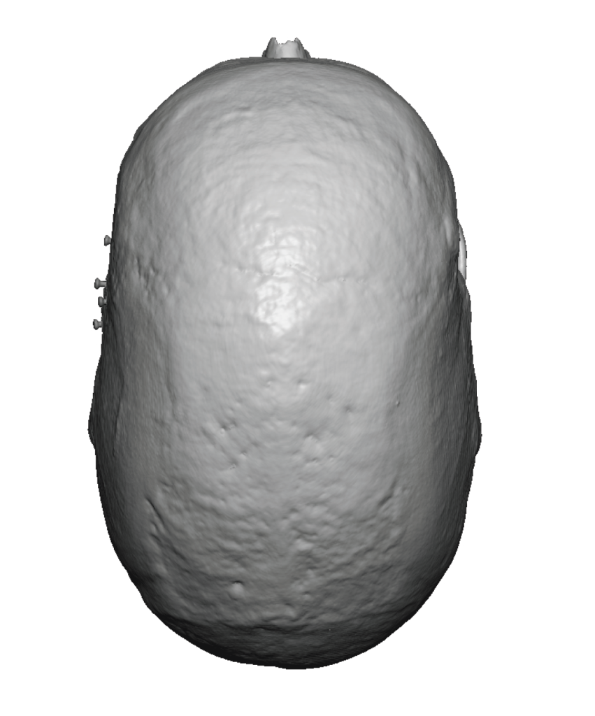 Plastic Surgery Case Study - Long Term Results of Custom Extended Head ...