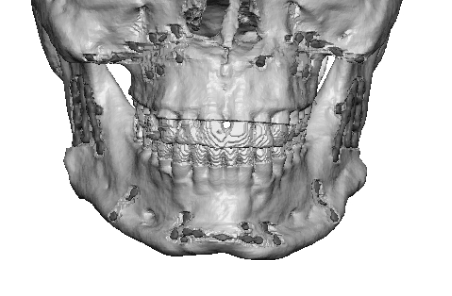 chin wing osteotomy 3D CT scan front view Dr Barry Eppley - Explore ...