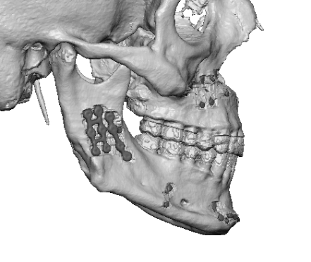 chin wing osteotomy 3D CT scan side view Dr Barry Eppley - Explore ...