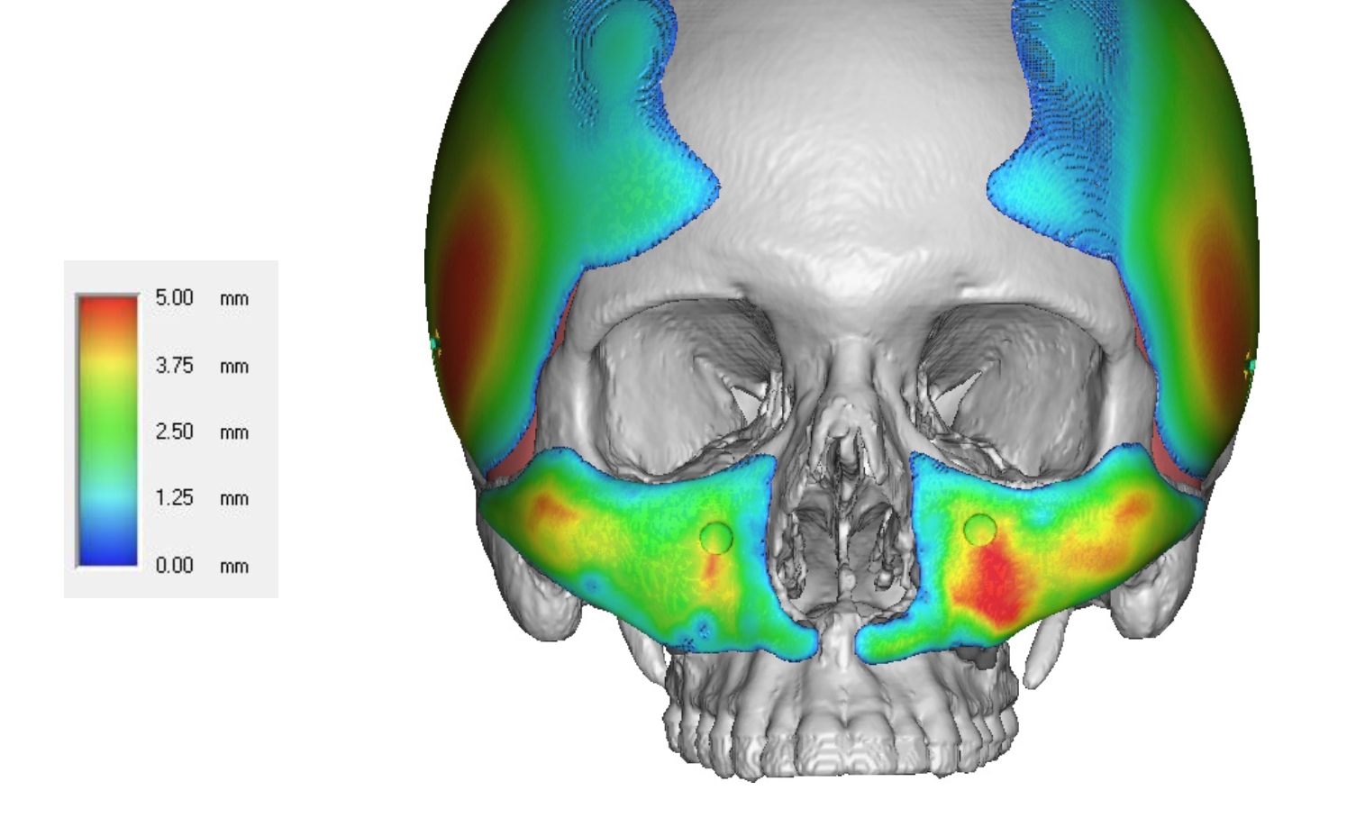 ciustom midface mask implant thicknesses Dr Barry Eppley - Explore ...
