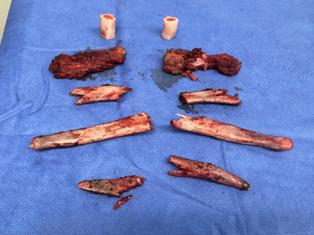 clavicle and rib removal specimens Dr Barry Eppley - Explore Plastic ...