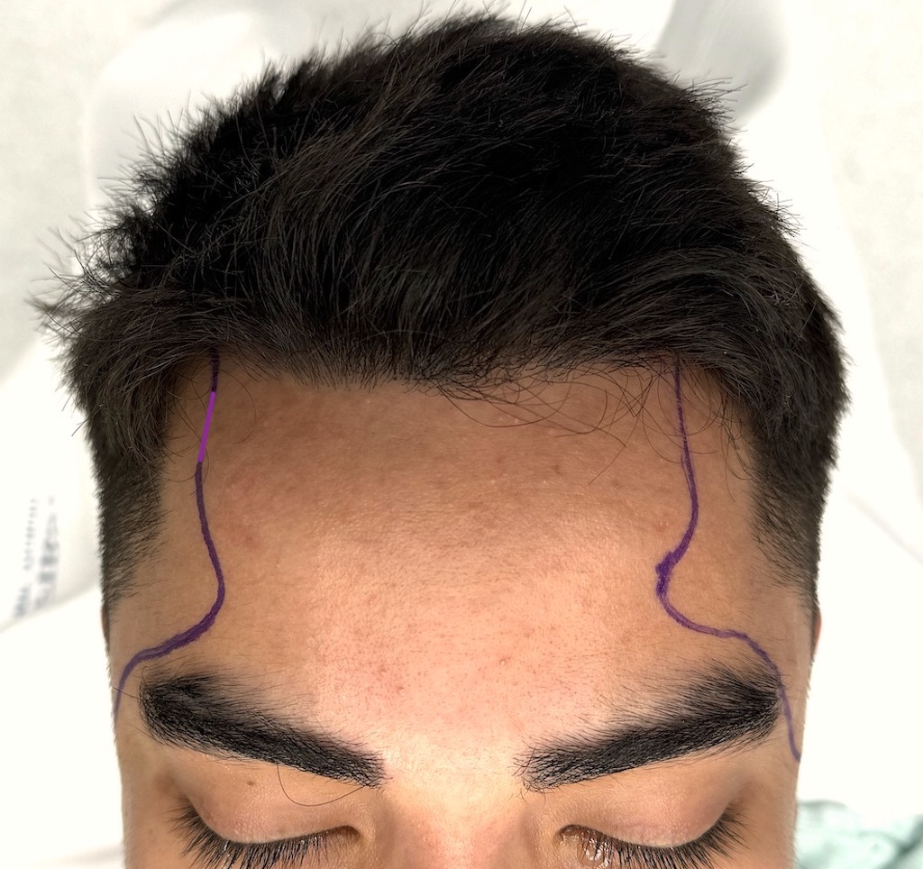 custom extended temporal implants marlimngs Dr Barry Eppley - Explore ...