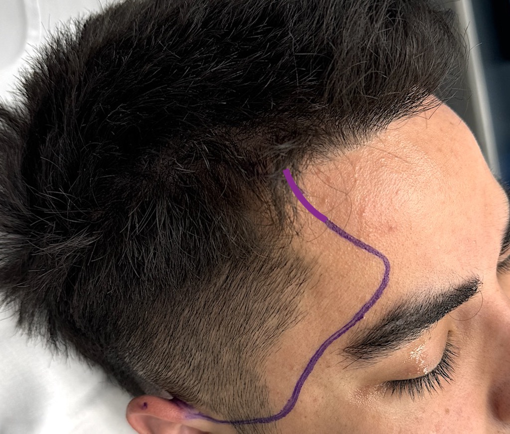 custom extended temporal implants marlkings right oblique view Dr Barry ...