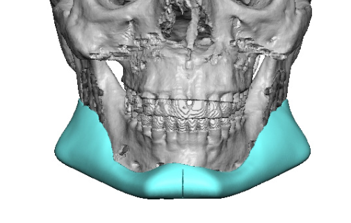 custom jawline implant design over chin wing osteotomy front view Dr ...