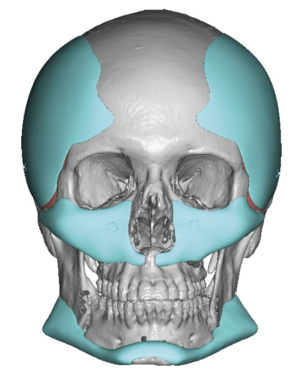 custom midfacve mask implant design front view Dr Barry Eppley ...