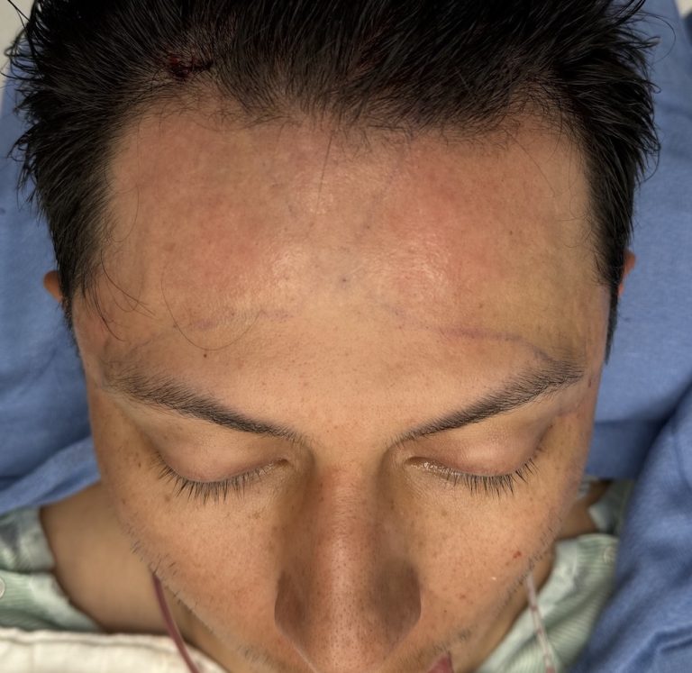 Plastic Surgery Case Study - Type 4 Temporal Augmentation Wrap Around ...