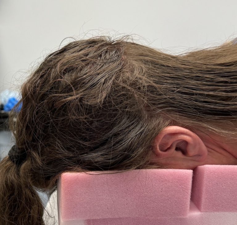 Plastic Surgery Case Study - The Two Stage Technique in Female Large ...