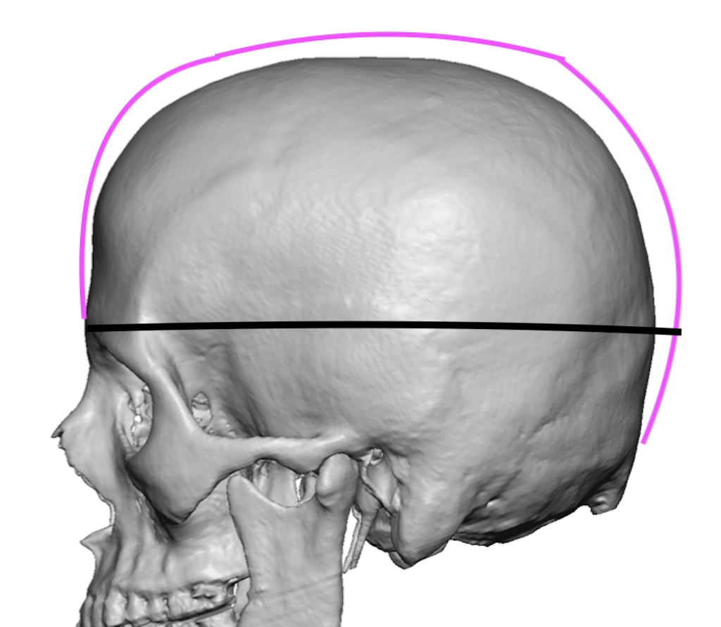 Plastic Surgery Case Study - Male Crown Of the Skull Reduction ...