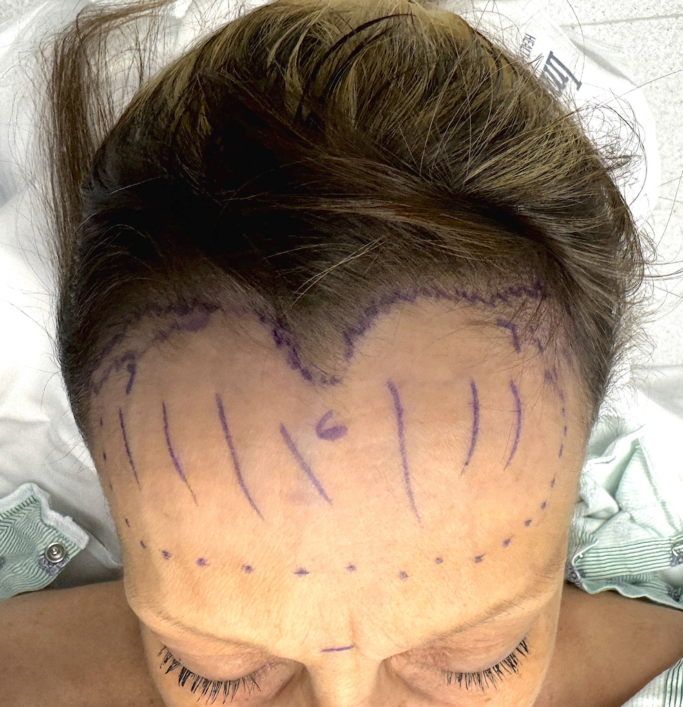 Plastic Surgery Case Study - Composite Forehead Reduction (Frontal ...